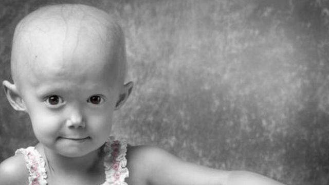 Progeria: así es el único caso en España - Telecinco