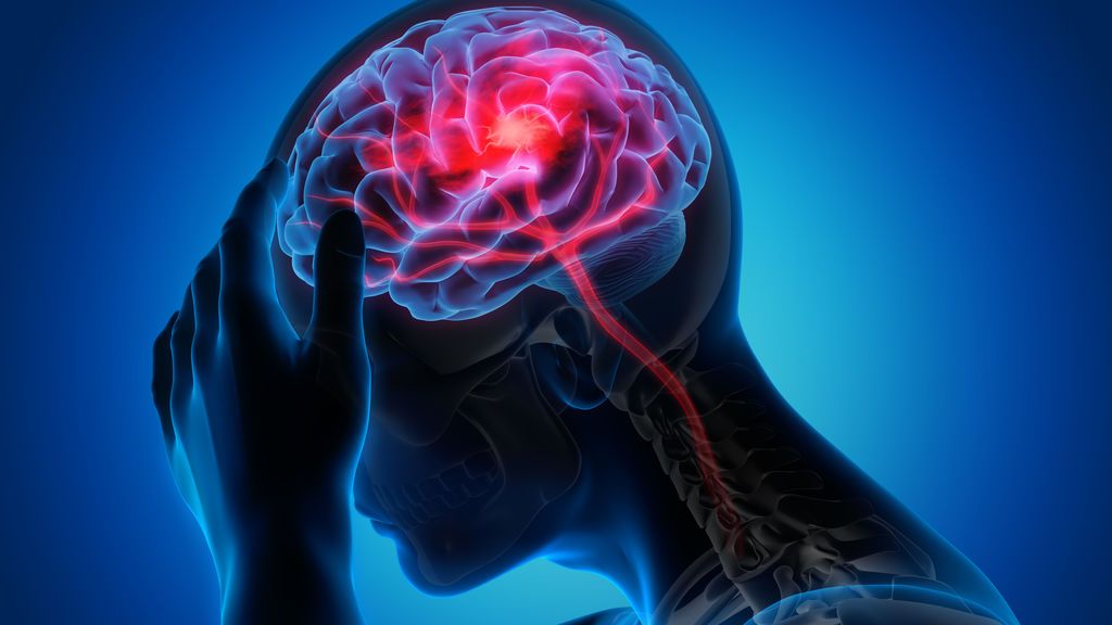 Qué Es El Ictus Isquémico Y Cuáles Son Sus Causas Y Sus Síntomas