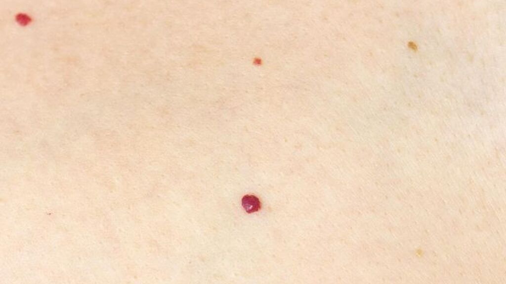 Por qué salen los puntos rojos en la piel y cómo evitarlos