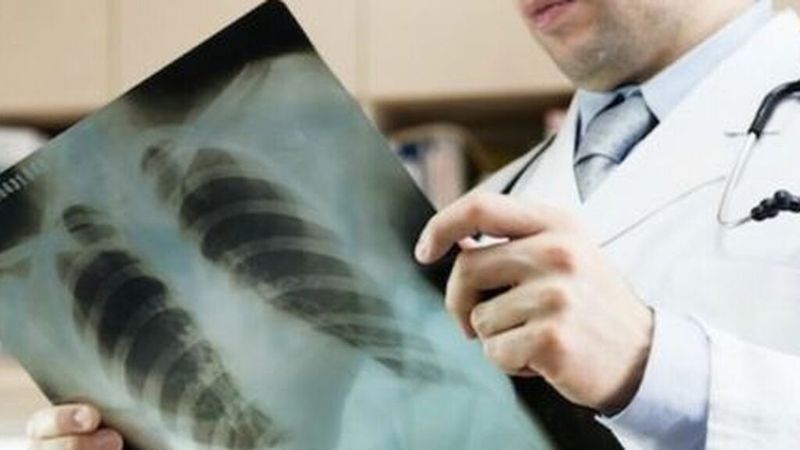 La joven Karen Carpenter exhibió el drama de la anorexia