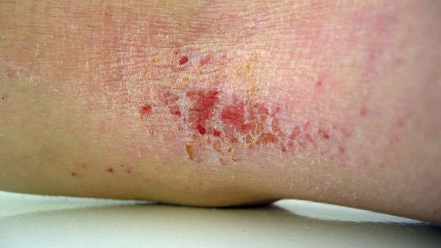 Cómo detectar una infección en la piel: así debes actuar