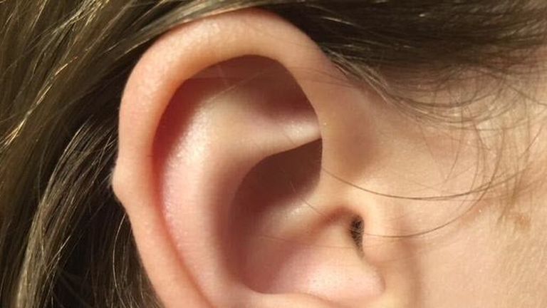 Tubérculo de Darwin en niños: qué es, para qué sirve y tratamiento ...