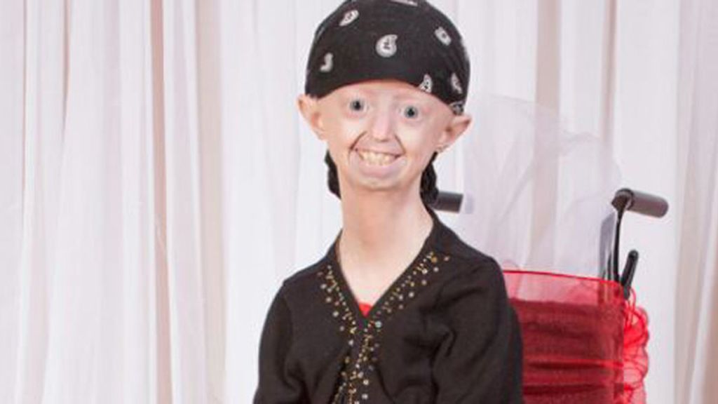 Muere Hayley Okines, la adolescente que envejeció antes de tiempo