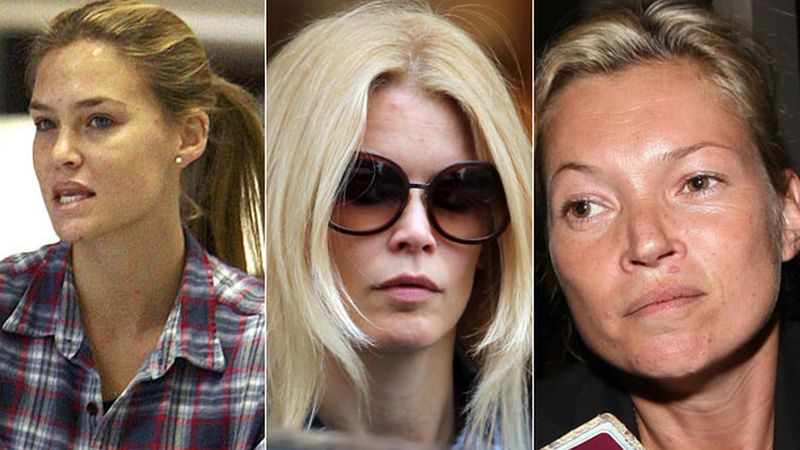 Los famosos también sufren con el acné