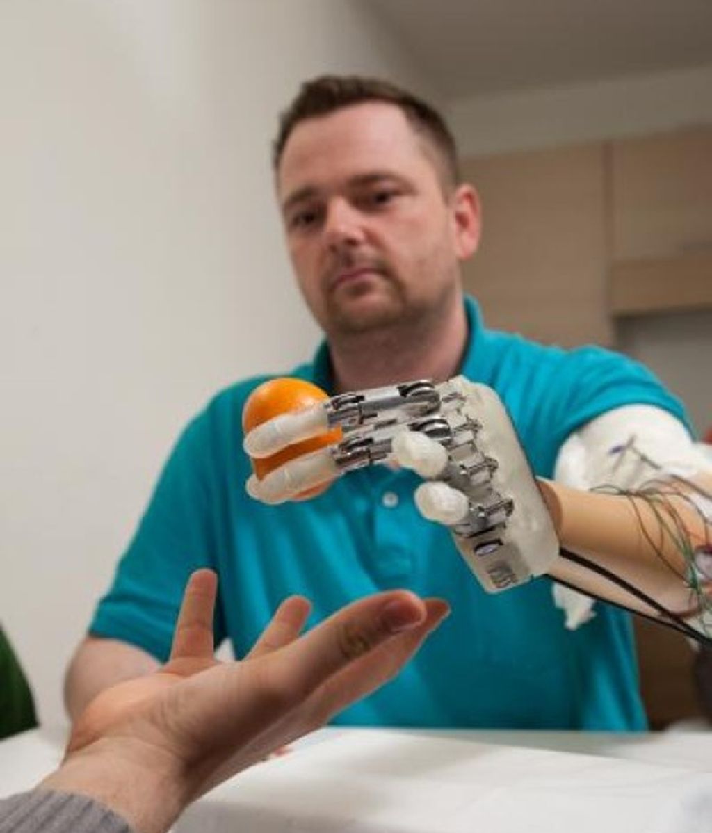 Implantan una prótesis de mano con sentido del tacto