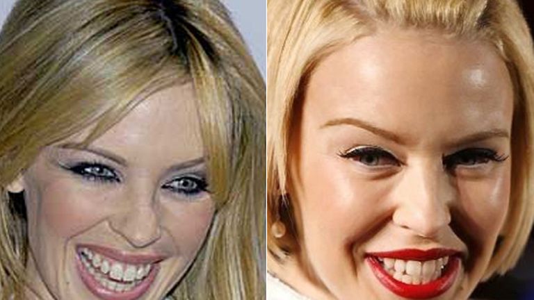 Cinco usos del bótox que tal vez no conoces: ¡no solo quita arrugas!