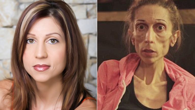 Rachael Farrokh, la actriz anoréxica que pesa solo 20 kilos, recauda ...