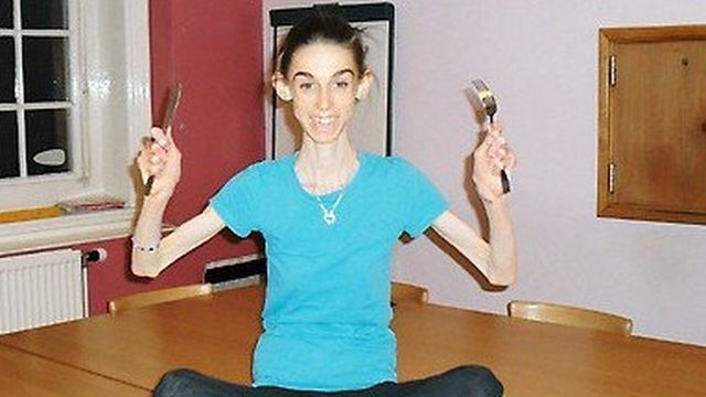 El peor caso de anorexia jamás visto