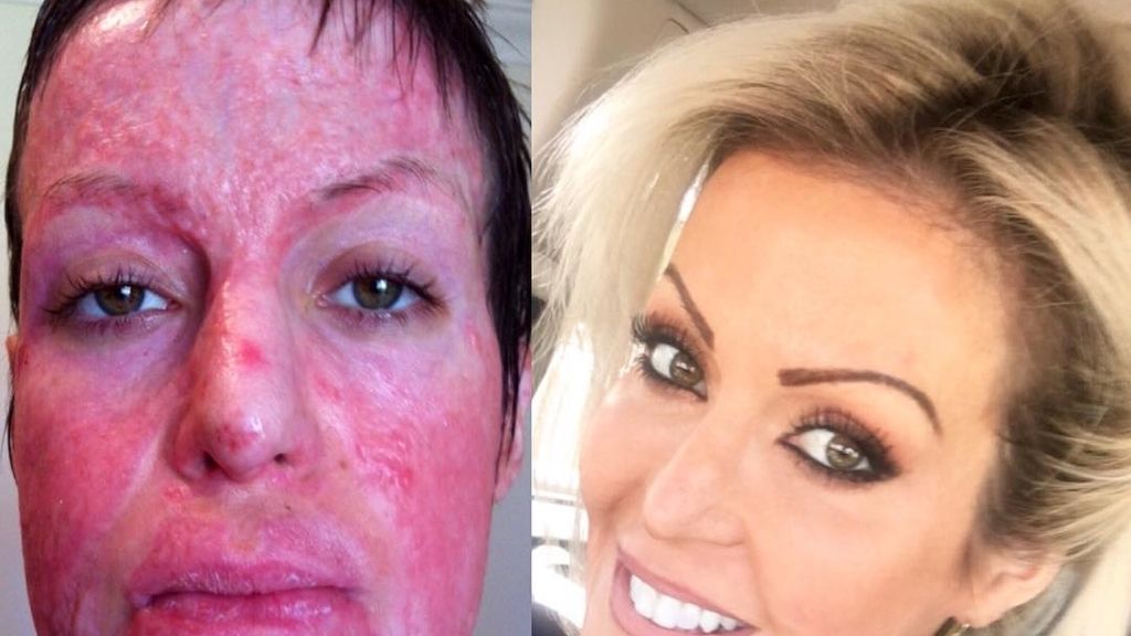 Esta mujer fue quemada viva...4 años después es un ejemplo de superación