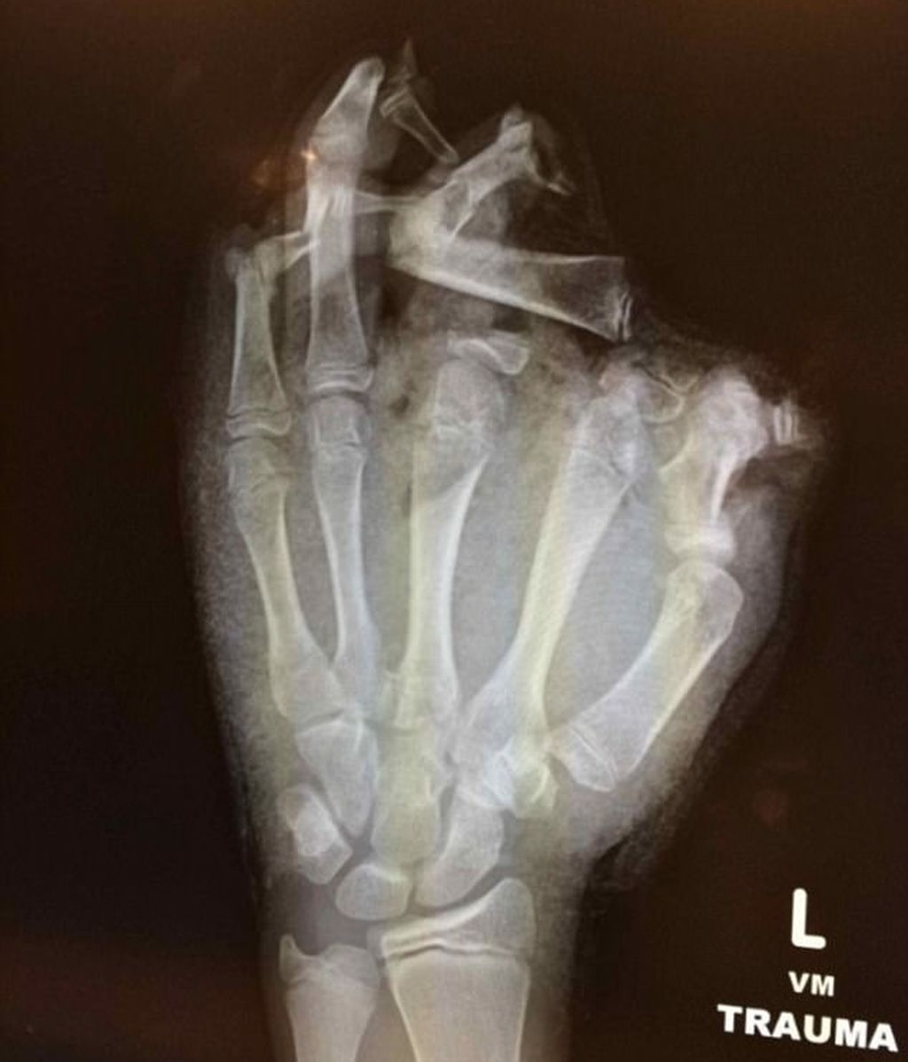 Las terribles lesiones de un joven que manipulaba fuegos artificiales