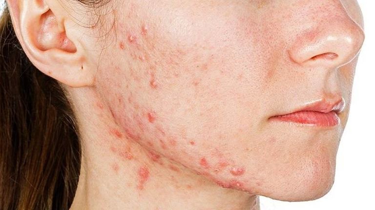 Acné más allá de los 30 años: ¿qué hago?