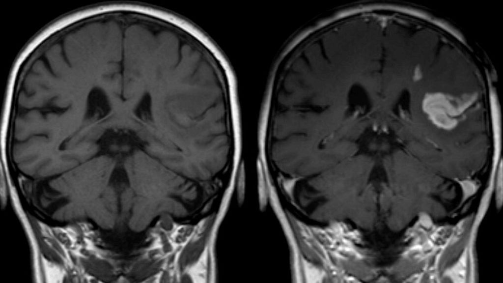 Ictus cerebral: síntomas de alarma y causas - Telecinco
