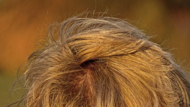 ¿Por qué salen escamas en la cabeza de un adulto? - Uppers