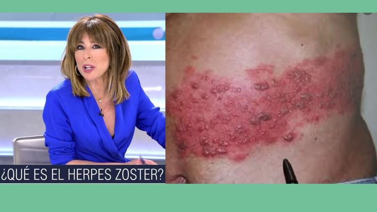 ¿Qué es el herpes zoster?
