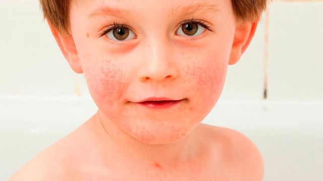 Escarlatina en niños: qué es, cómo se cura y cuánto dura - Divinity