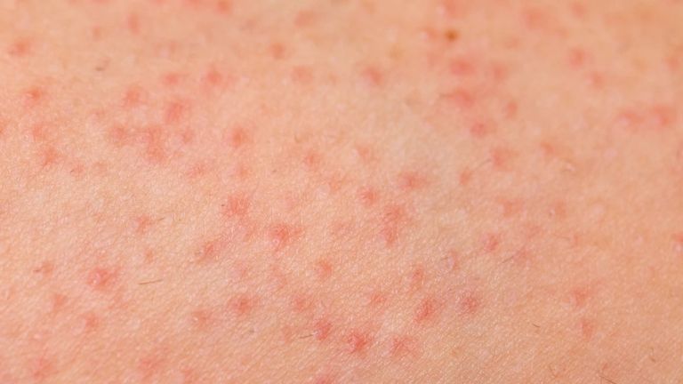 ¿Qué es la miliaria, el sarpullido por calor? - Uppers