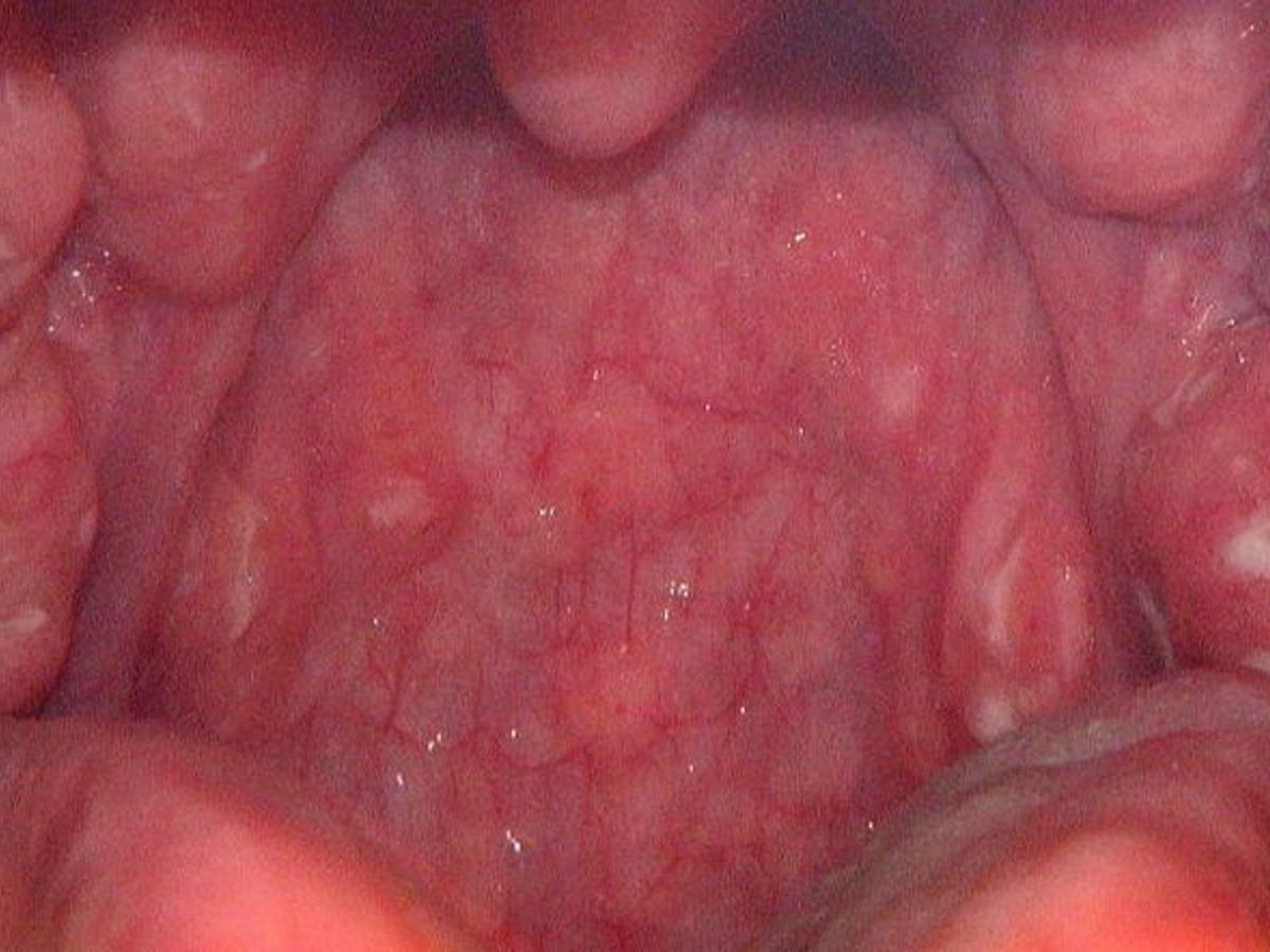 Infeccion De Garganta