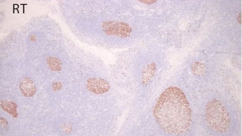 Todas las respuestas sobre las infecciones estreptocócicas del grupo A