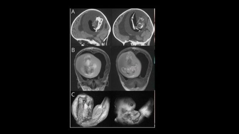 Extraen el feto vivo de su hermano en el cerebro de una niña de 1 año