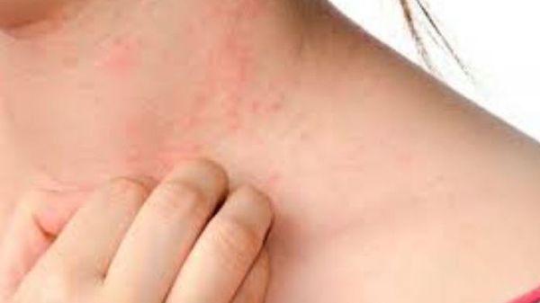 Aumentan los casos de sarna en San Sebastián