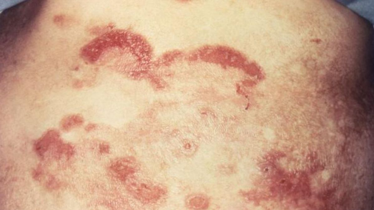 Micosis fungoide: ¿qué es, a quién afecta y cómo identificarla?