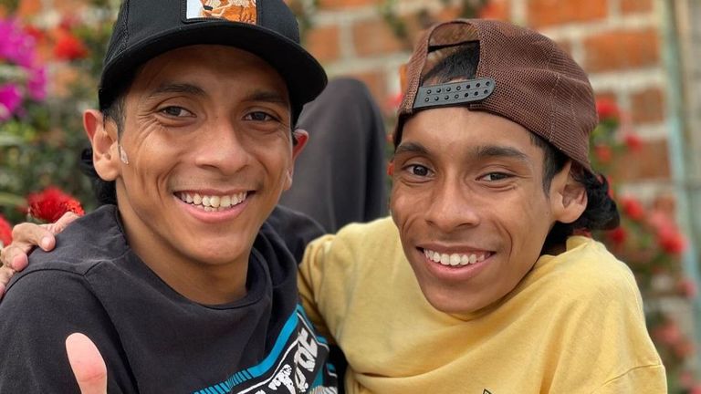 Vivir siendo siameses: "Uno puede estar muy enfermo y el otro bien"