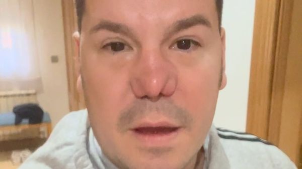 Lucas, de 'Andy y Lucas', se operará la nariz: el duro preoperatorio al ...